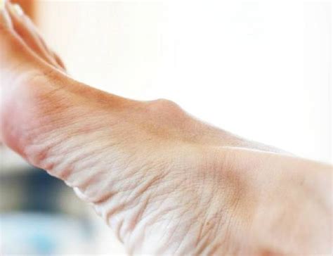 Little Bumps On Side Of Foot
