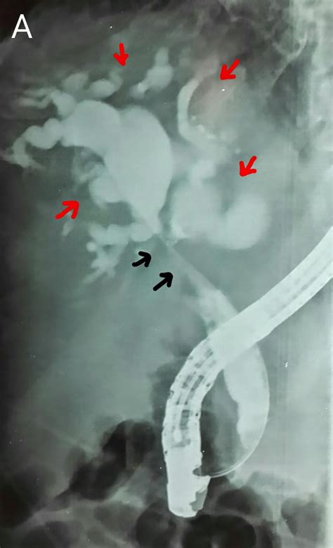 Ercp And Egd Managing A Hilar Stricture Or Trying To At Least