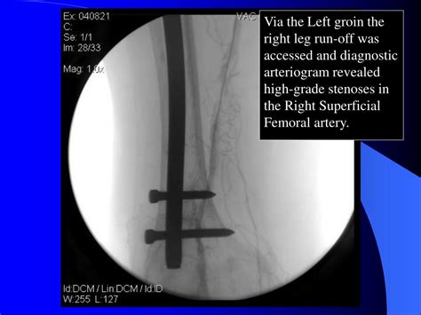 Ppt Right Leg Re Vascularization Powerpoint Presentation Free