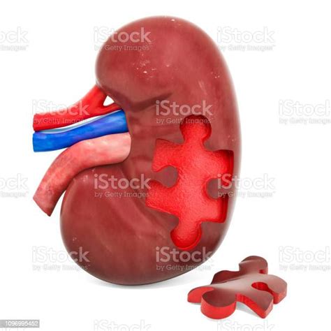 신장 질환이 나 감염 개념 3d 렌더링에 고립 된 흰색 배경 암종에 대한 스톡 사진 및 기타 이미지 암종 콩팥 내부 기관 3차원 형태 Istock