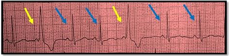 A Ecg Of A 21 Year Old Female With Intermittent Wpw Pattern Download Scientific Diagram