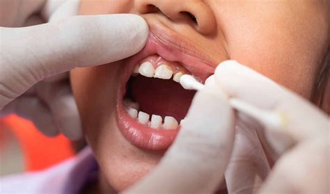 Fort Myers Pediatric Dentists Smilee Pediatric Dentistry