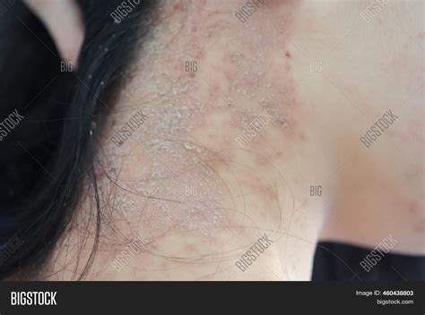 Skin Rash On Back Of Neck Pictures At Timothy Gordon Blog