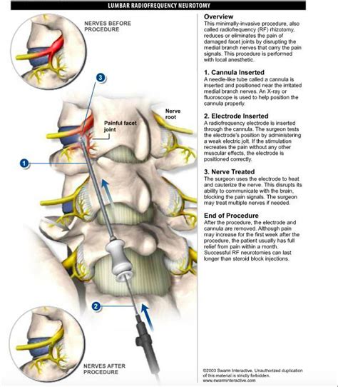 What Is Radiofrequency Nerve Ablation At Madeline Hardwicke Blog