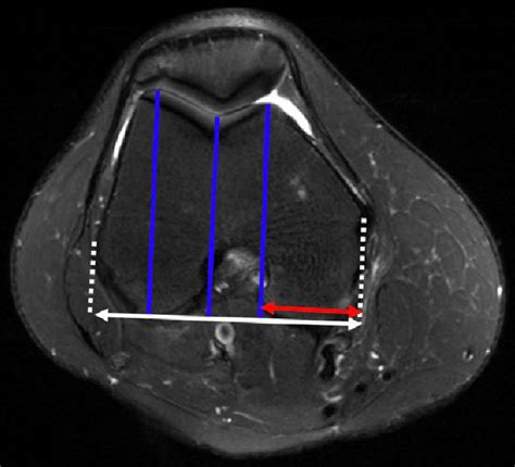 To Assess The Role Of The Trochlear Position On The Femur The Deepest