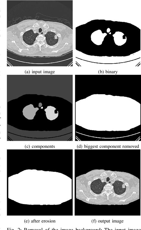 Figure 1 From Automated Lung Tumor Detection And Diagnosis In Ct Scans Using Texture Feature