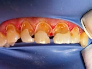 Compositebuildup Hill Park Dental