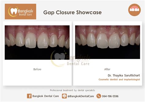 Gap Closure Bangkok Dental Care