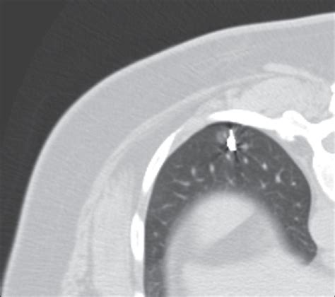 Computed Tomography Guided Pulmonary Nodule Microcoil Localization Technique Misplacement