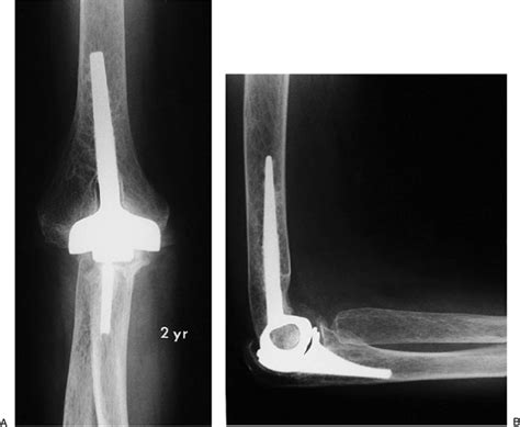 Phalanx Dislocation Teachme Orthopedics