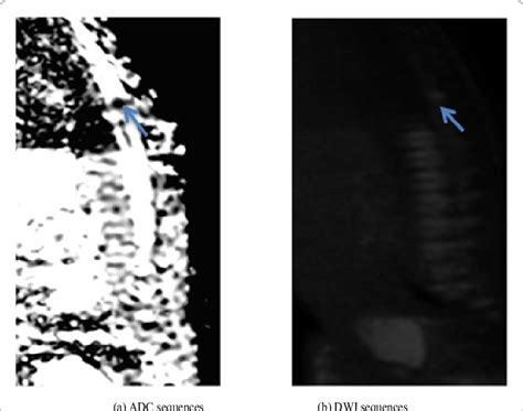 A Adc And B Dwi Sequences Respectively Show Diffusion Restriction Download Scientific
