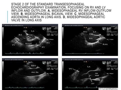 Transesophageal Echocardiographypptx