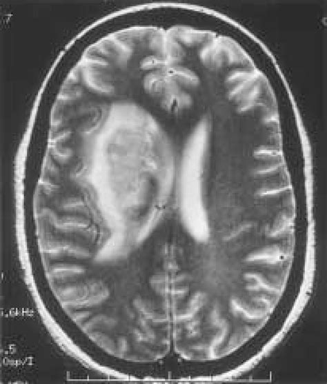 Magnetic Resonance Imaging Large Intracranial Hemorrhage With Moderate