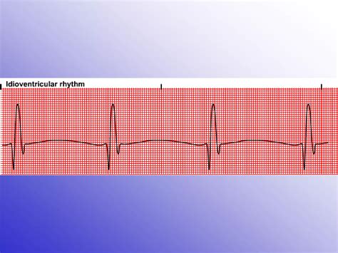 Arrhythmia Diagnosis And Management Ppt