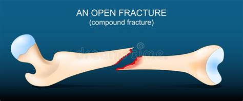 Compound Fracture Of Human Femur Bone Stock Vector Illustration Of