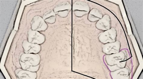 The Amsa Nerve Block Pair With The Psa Nerve Block For Hemimaxillary Anesthesia Registered