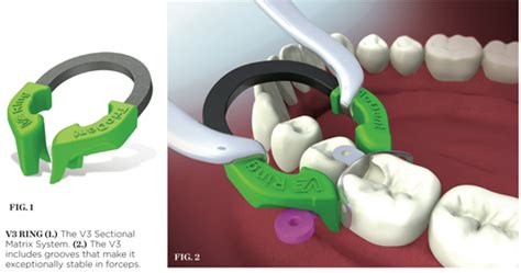 V3 Sectional Matrix System Triodent Nov Dec 2009 Inside Dentistry