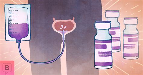 Starting BCG Treatments What To Expect Before During And After