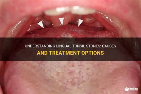 Understanding Lingual Tonsil Stones Causes And Treatment Options Medshun