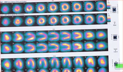 Perfusion Image Of Index Case Download Scientific Diagram