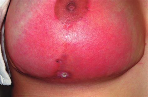 Celulitis En Post Quirúrgico De Cirugía Mamaria Fuente Autor