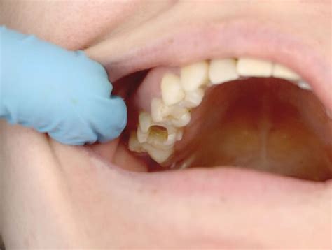 Swollen Taste Buds 8 Obvious Causes Of Your Discomfort