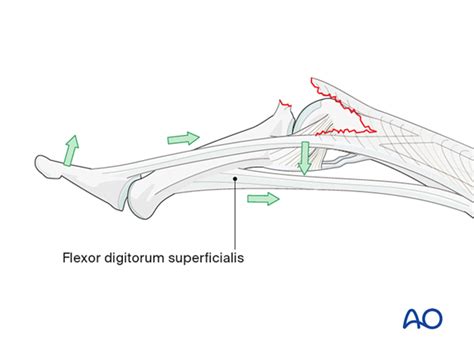 Dislocation Of The Proximal Interphalangeal Joint
