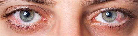 Staph Eye Infection Contagious Staph Eye Infection Symptoms Causes