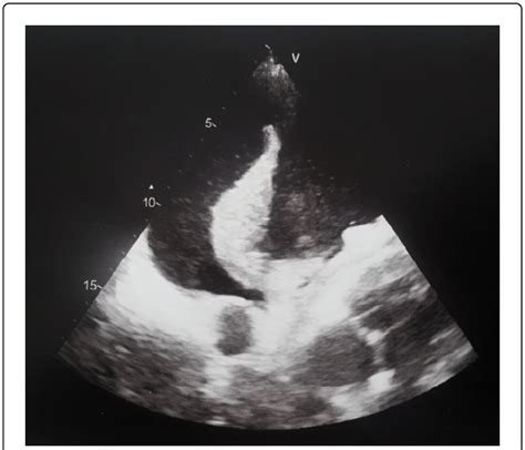 Pleural Effusion Containing Dense Fibrin Deposits Detected By