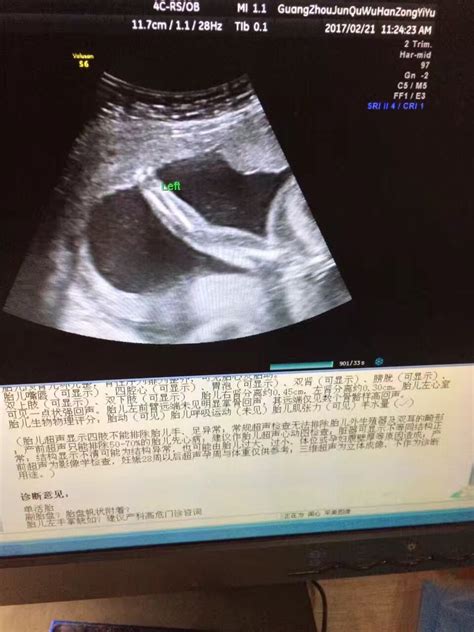 胎儿畸形