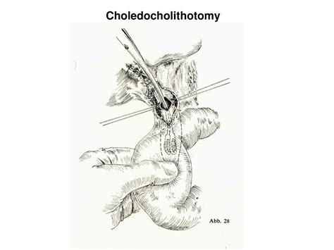 Postcholecystectomic Syndrome Ppt Download