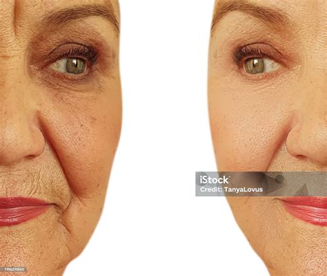 치료 전후 콜라주 콜라주를 주름 노인 여성의 얼굴 개념에 대한 스톡 사진 및 기타 이미지 개념 개념과 주제 개선 Istock