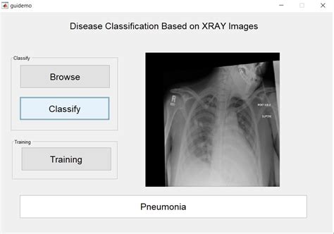 pdf pneumonia detection using x ray image processing