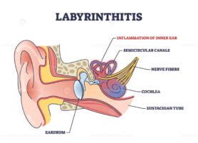 Labyrinthitis As Inner Ear Infection And Medical Inflammation Outline