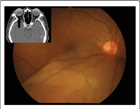Figure 1 From Choroidal Metastases From Breast Cancer Semantic Scholar