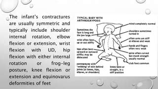 Arthrogryposis Multiplex Congenita Pptx
