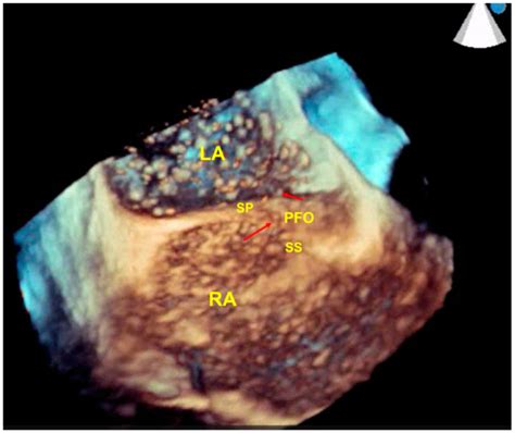 Patent Foramen Ovale And Cryptogenic Stroke Integrated Management Pmc