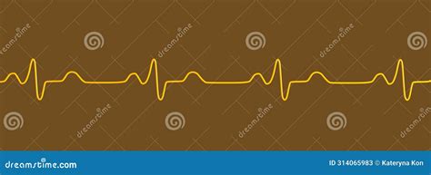Ecg Of Bundle Branch Block 3d Illustration Royalty Free Cartoon 314065940
