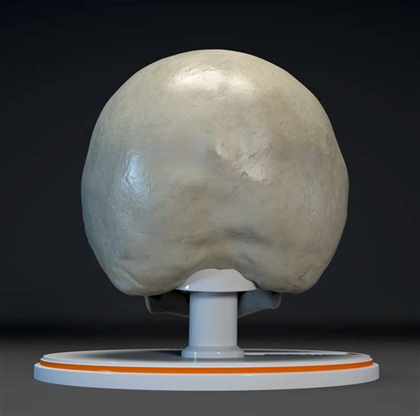 Custom 3d Anatomy Models Craniosynostosis Lambdoid Suture Pfeiffer Syndrome Crouzon