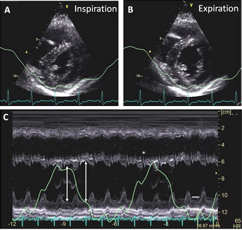 Multimodality Imaging In Differentiating Constrictive Pericarditis From