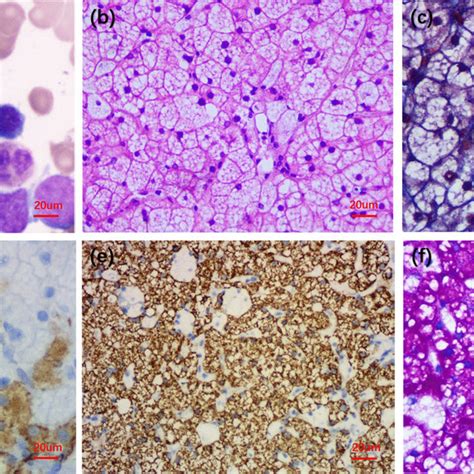 A Smears Of Bone Marrow Aspiration Revealed Sea Blue Histiocytes