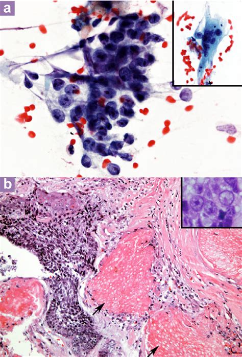 A Aspirate Shows Loose Clusters Of Atypical Basaloid Cells