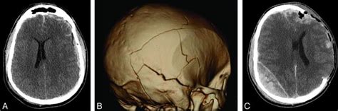 Calvarial Fracture Patterns On Ct Imaging Predict Risk Of A Delayed