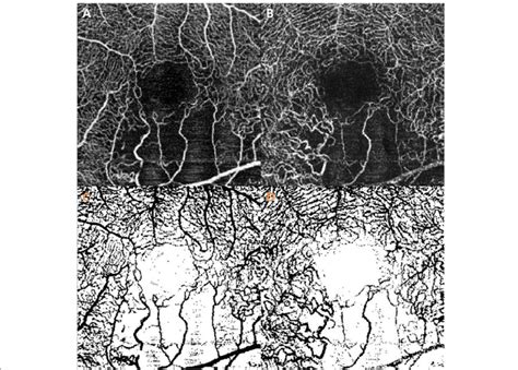Macular Vessel Density Assessment Using The Binarization Process The Download Scientific