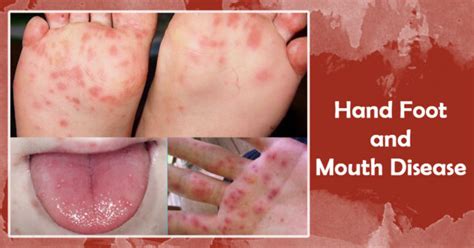 Information On Hand Foot Mouth Disease Outlet
