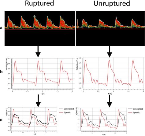 Two Patient Specific Inflow Waveforms A Ruptured And An Unruptured