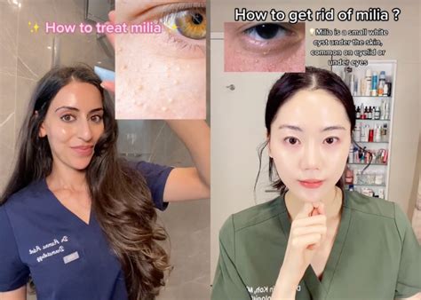 The Best Milia Seeds Removal Treatments In Singapore