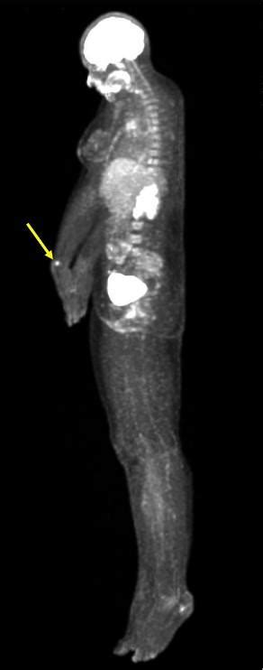Osteoblastoma Like Osteosarcoma With Local Recurrence In The Distal Radius Eurorad
