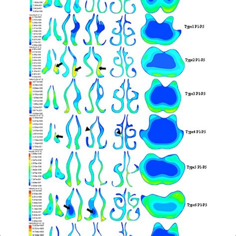 Pdf Impact Of Varying Types Of Nasal Septal Deviation On Nasal Airflow Pattern And Warming
