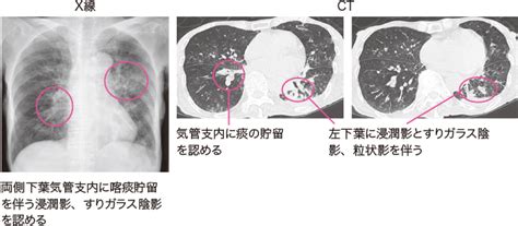誤嚥性肺炎 看護roo カンゴルー
